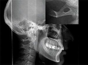The Arcuate Foramen Can Have Clinical Consequences